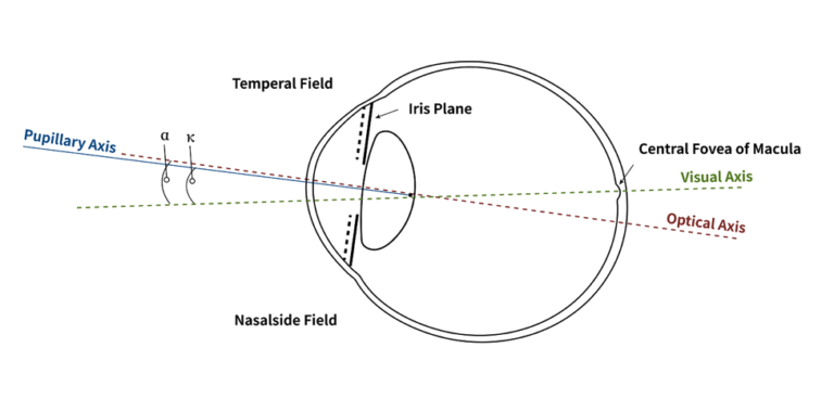 How α angle and κ angle Play a Key Role in Anterior Segment of Eye ...