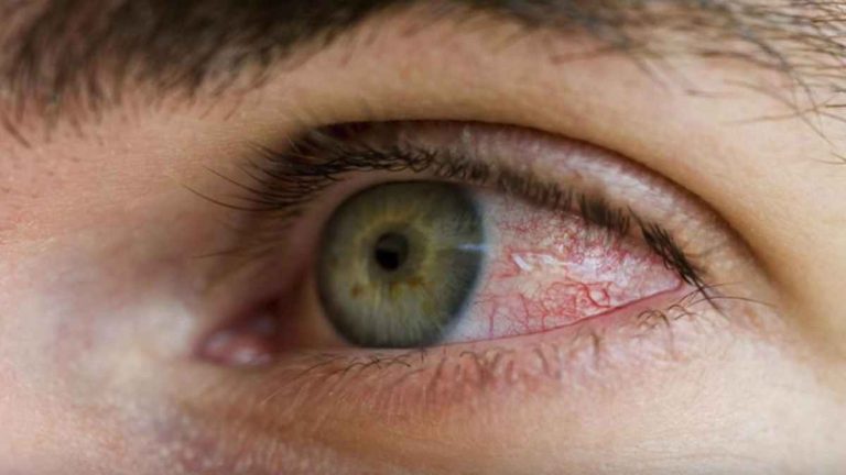 Why is Weed Making your Eyes Red? - IMC Grupo